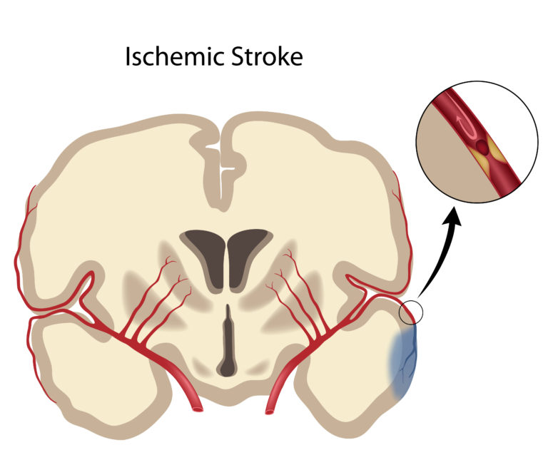 Acupuncture In Stroke Treatment - Art of Acupuncture